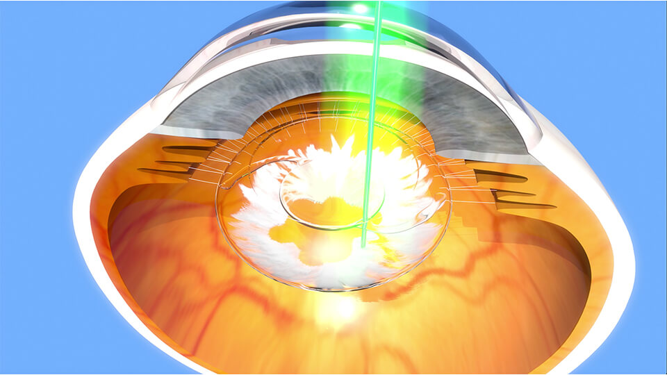 Eye Treatments Archive – Northpoint Eyecare