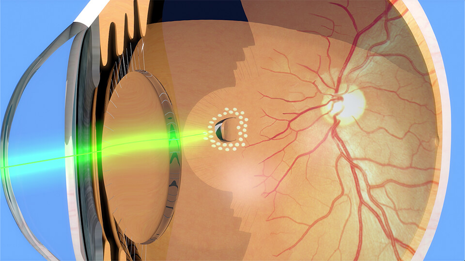 Eye Treatments Archive – Northpoint Eyecare