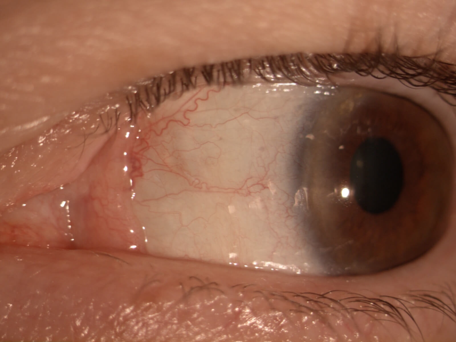 Whats that red thing on your eye? – Northpoint Eyecare