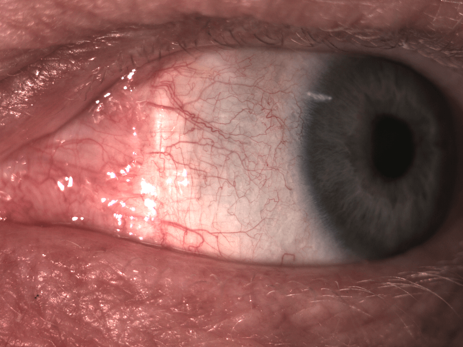 Whats that red thing on your eye? – Northpoint Eyecare